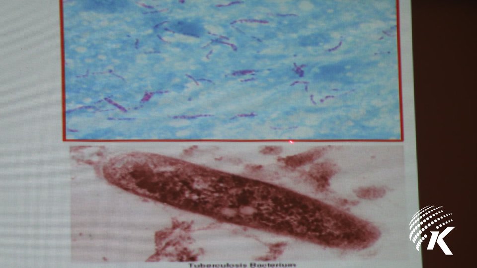 Preventing the Spread of Tuberculosis | Kiripost